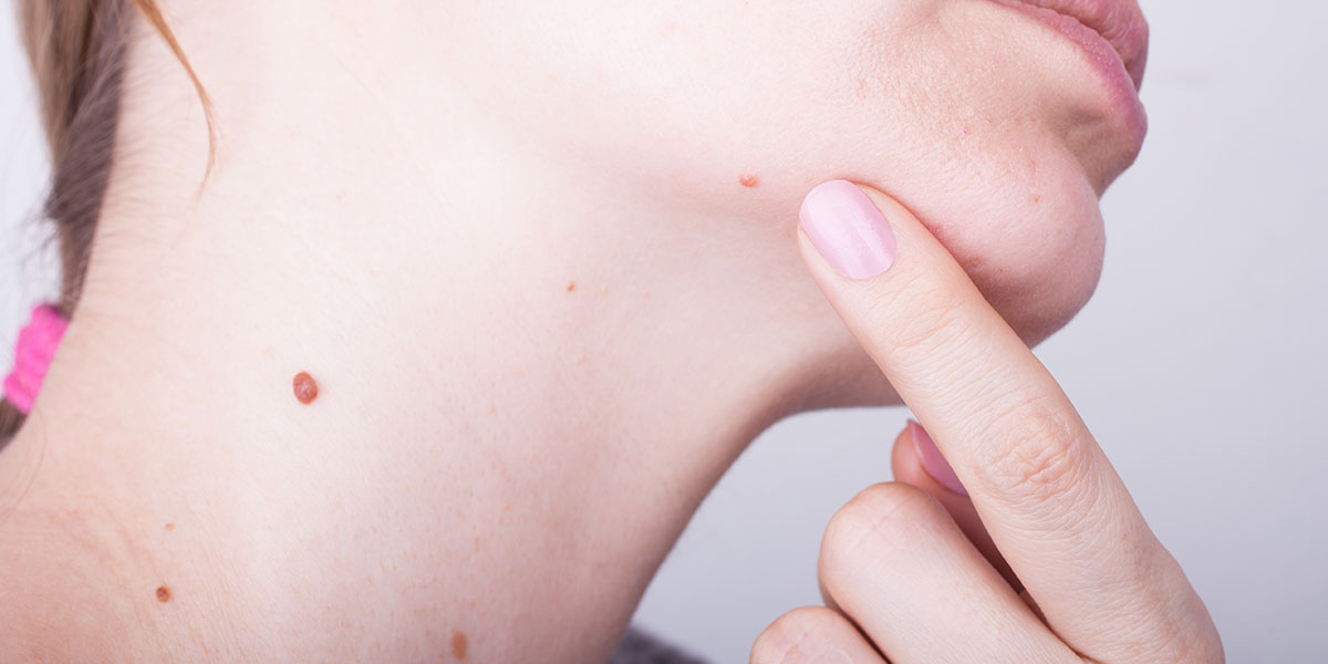 Cancer de la peau : savez-vous détecter les signes d'alerte