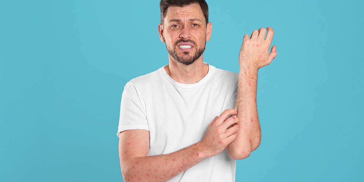 Variole du singe ou Monkeypox : ce qu'il faut savoir - CPR